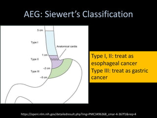 Esophageal cancer and adenocarcinoma of EGJ | PPTX