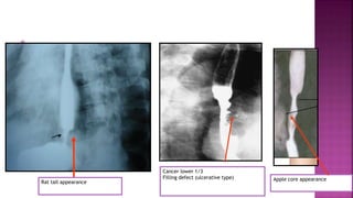 esophageal cancer staging.pptx