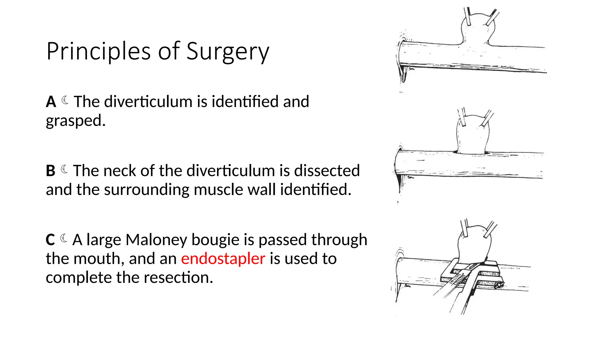 Esophago-pharyngeal Diverticula and their management | PPT