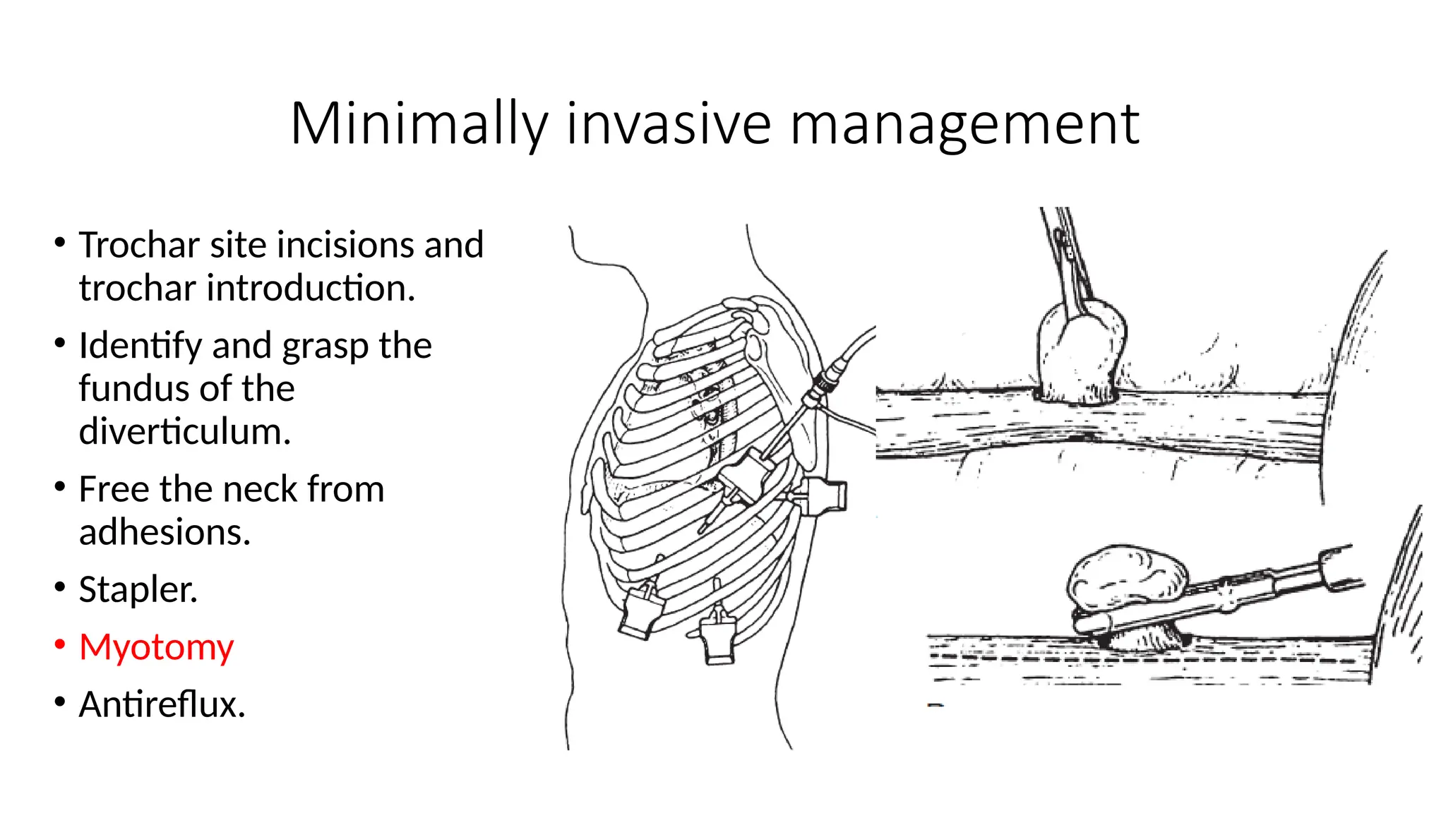 Esophago-pharyngeal Diverticula and their management | PPT