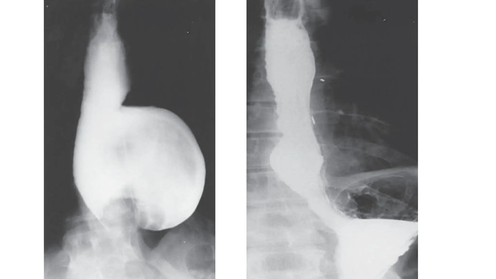 Esophago-pharyngeal Diverticula and their management | PPT