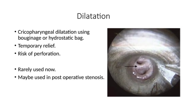 Esophago-pharyngeal Diverticula and their management | PPT