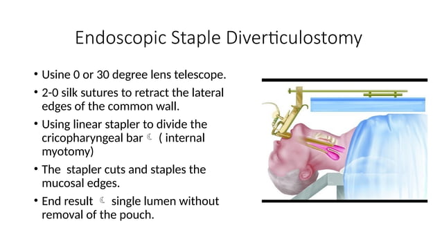 Esophago-pharyngeal Diverticula and their management | PPT
