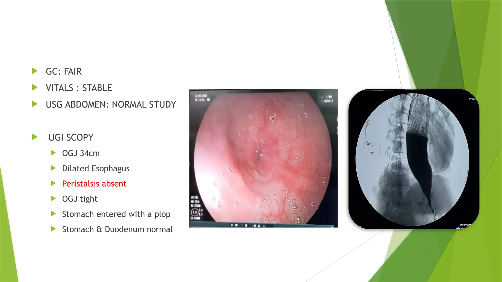 ESOPHAGEAL GASTRIC MOTILITY DISORDER.pptx