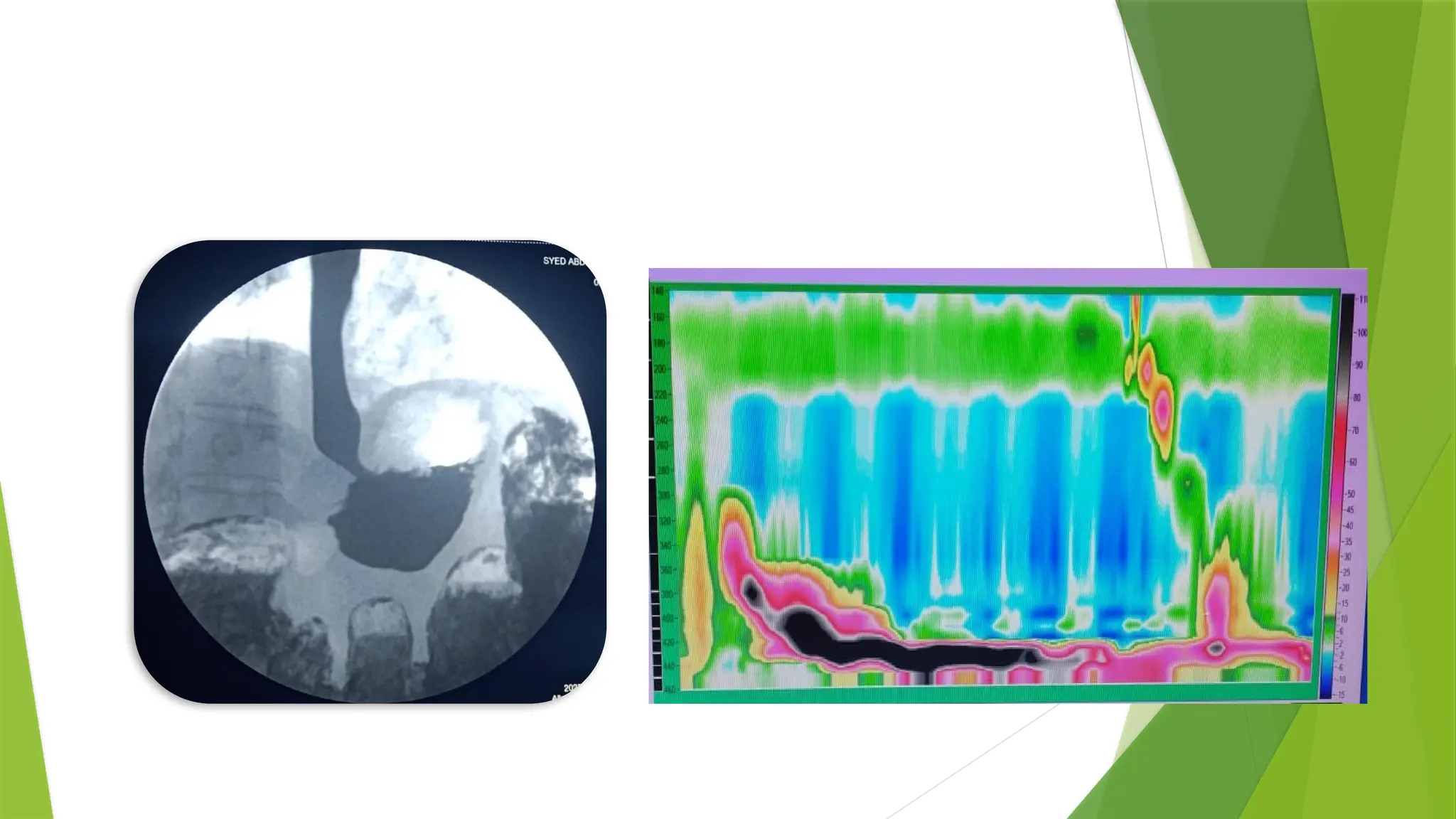 ESOPHAGEAL GASTRIC MOTILITY DISORDER.pptx