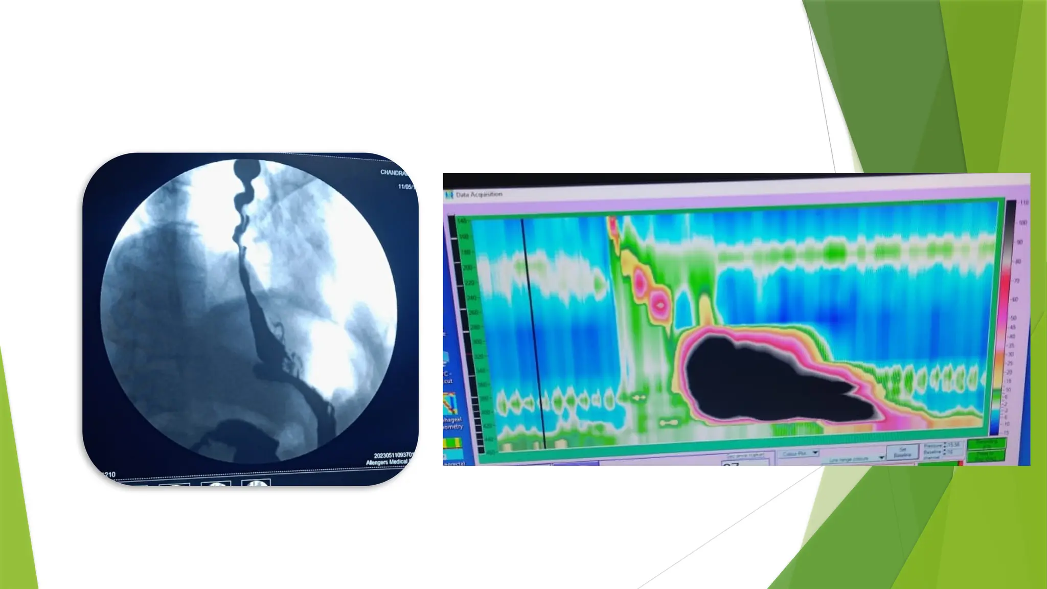 ESOPHAGEAL GASTRIC MOTILITY DISORDER.pptx