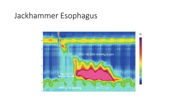 Esophageal Manometry.pptx | Digestive Disorders | Diseases and Conditions