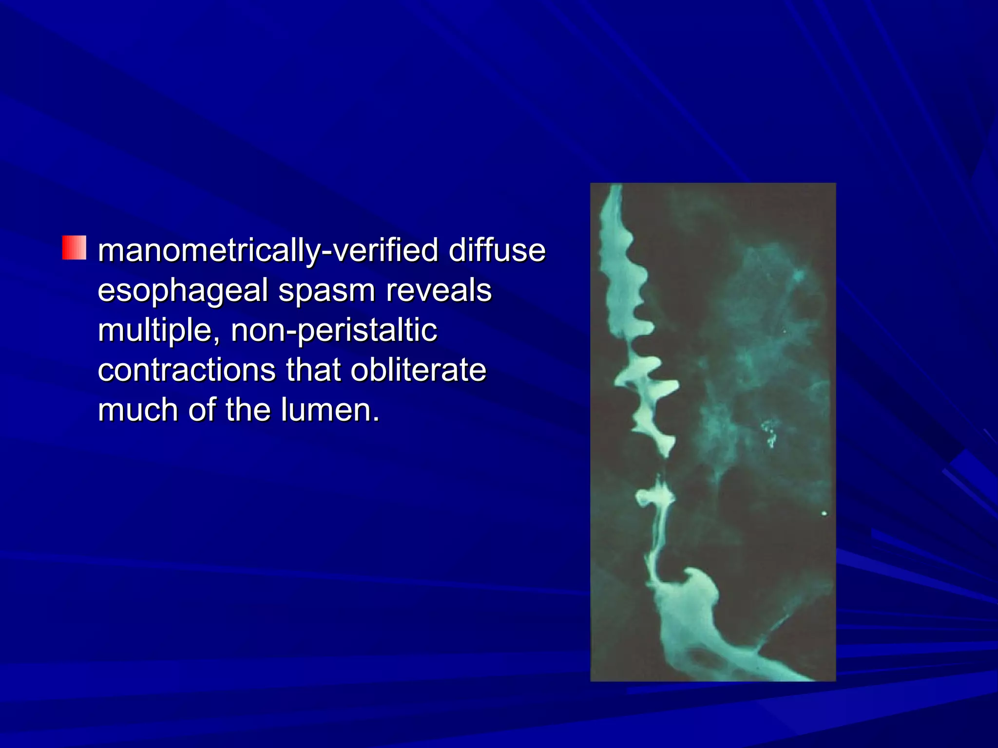 Esophageal motility disorders | PPT