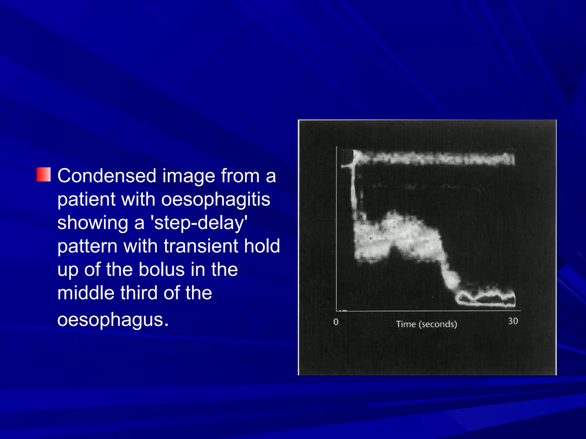 Esophageal motility disorders | PPT
