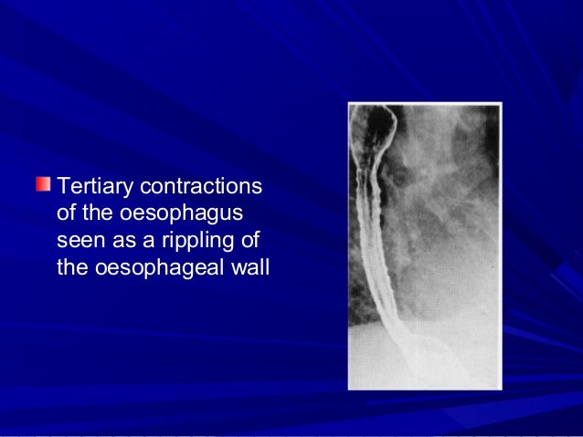 Esophageal motility disorders