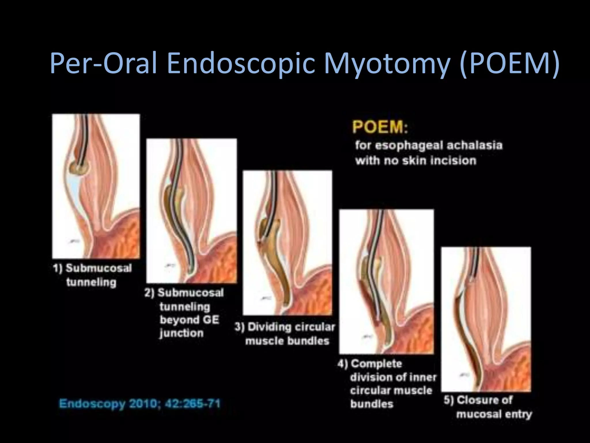 Esophageal motility disorders | PPTX | Digestive Disorders | Diseases ...