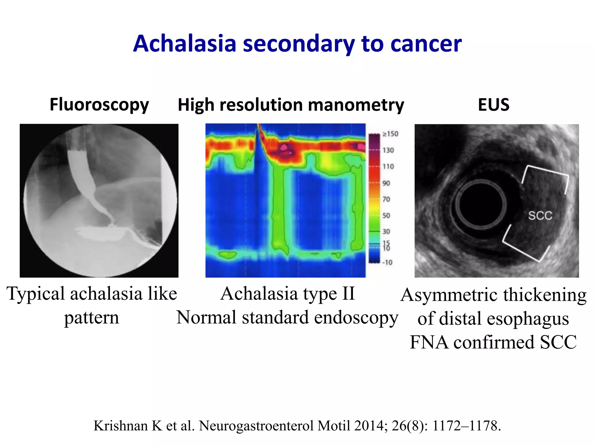 Esophageal motility disorders in Chicago classification v3.0 | PPTX