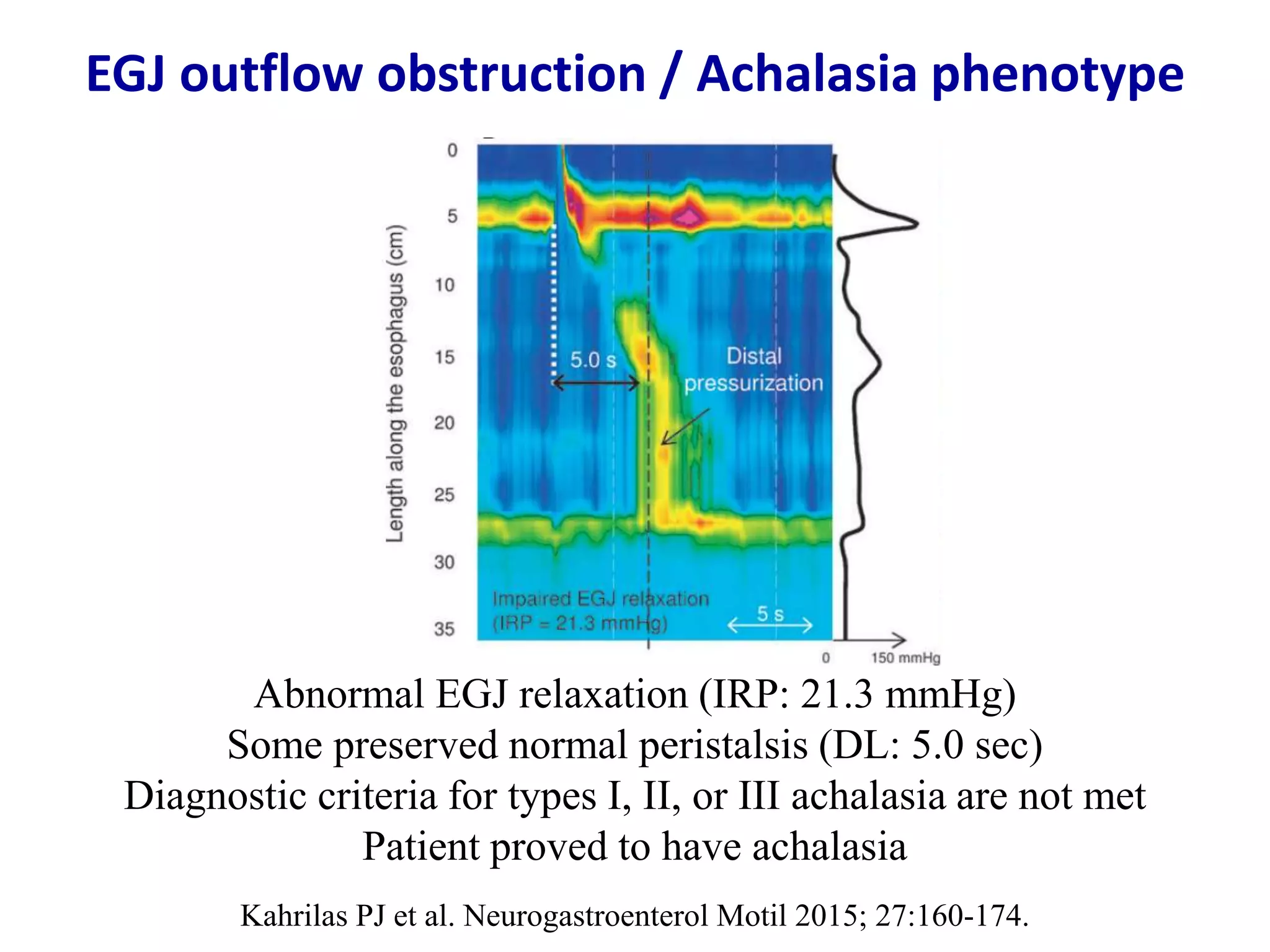 Esophageal motility disorders in Chicago classification v3.0 | PPTX