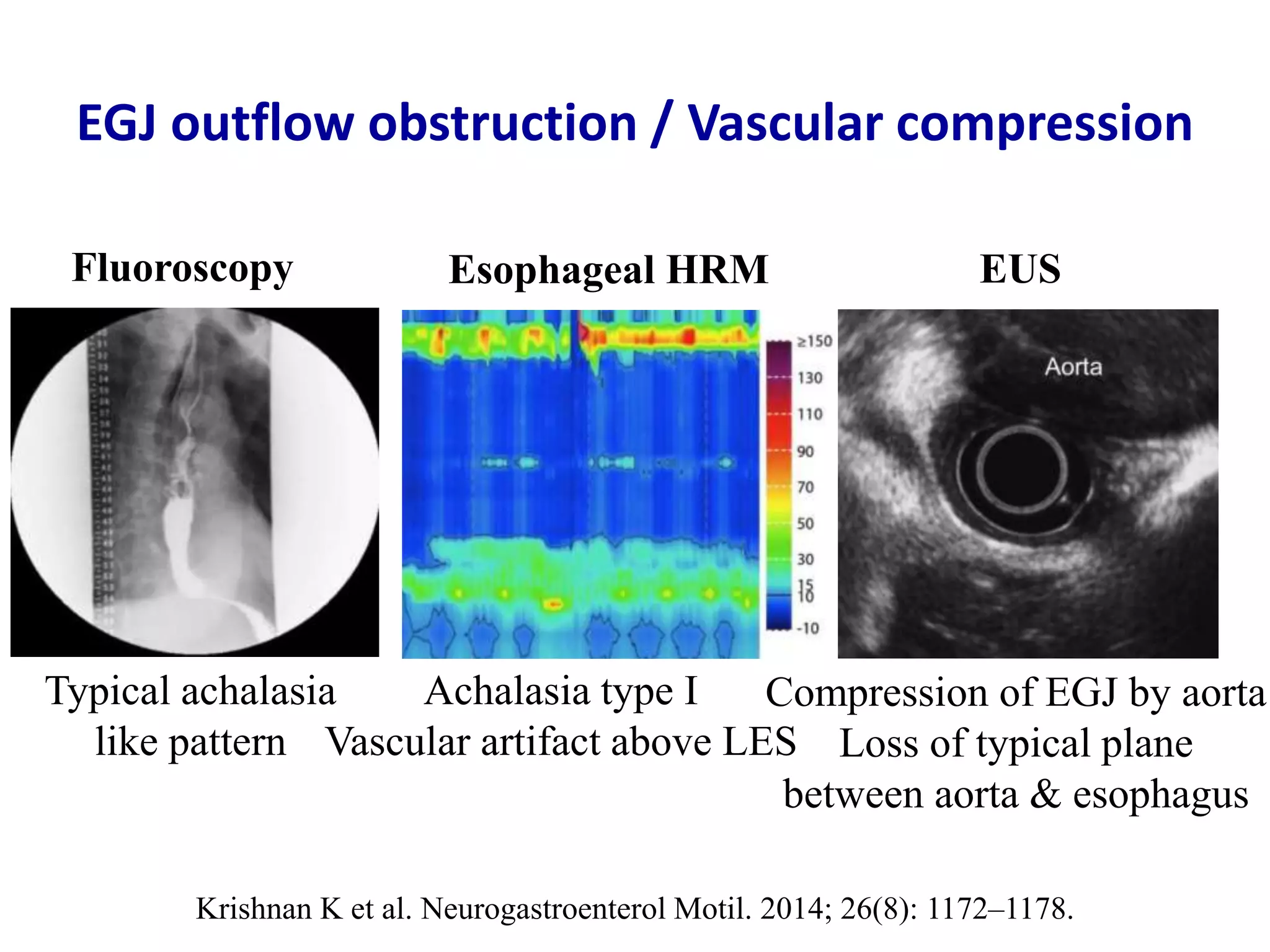 Esophageal motility disorders in Chicago classification v3.0 | PPTX