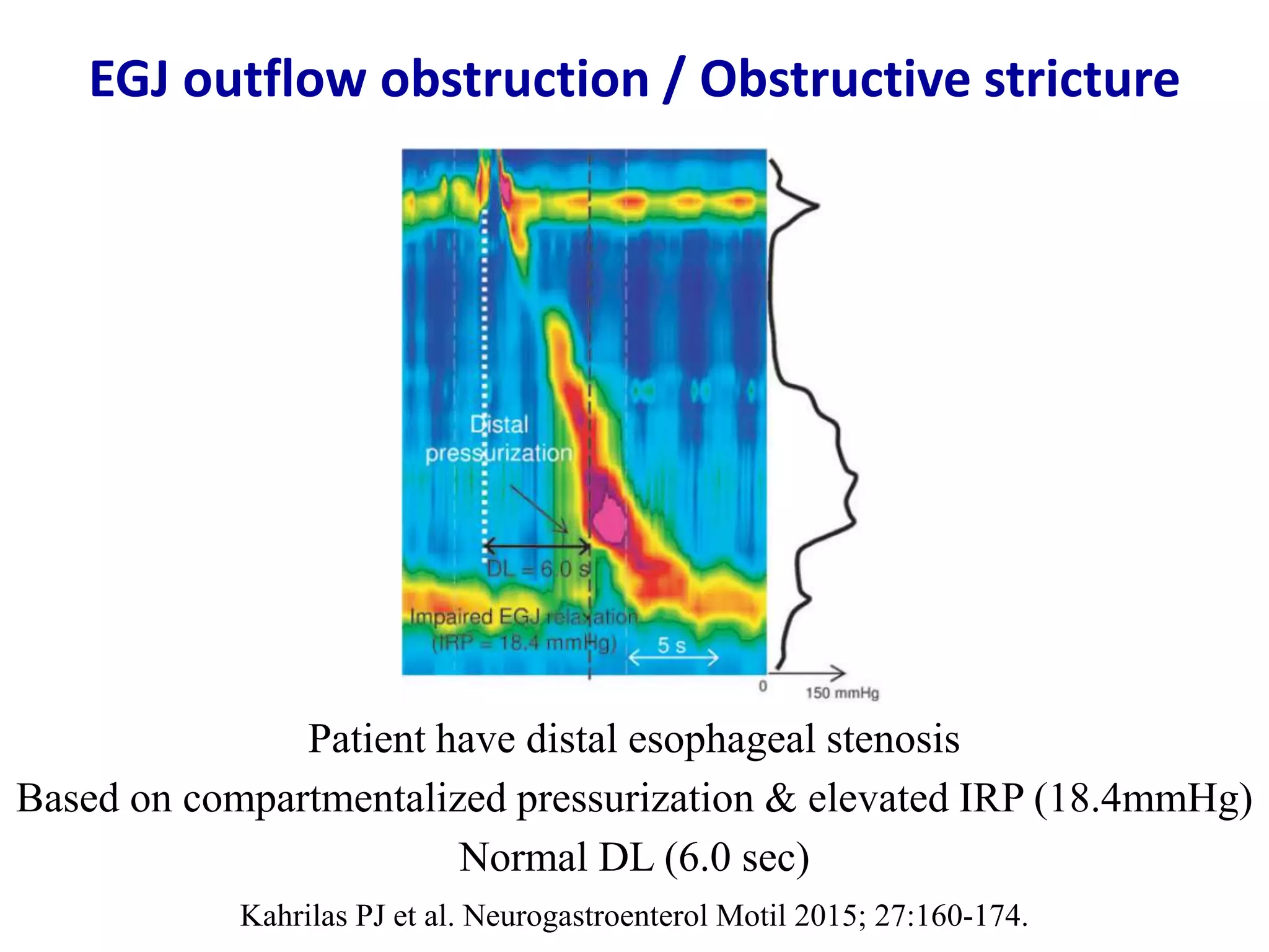 Esophageal motility disorders in Chicago classification v3.0 | PPTX