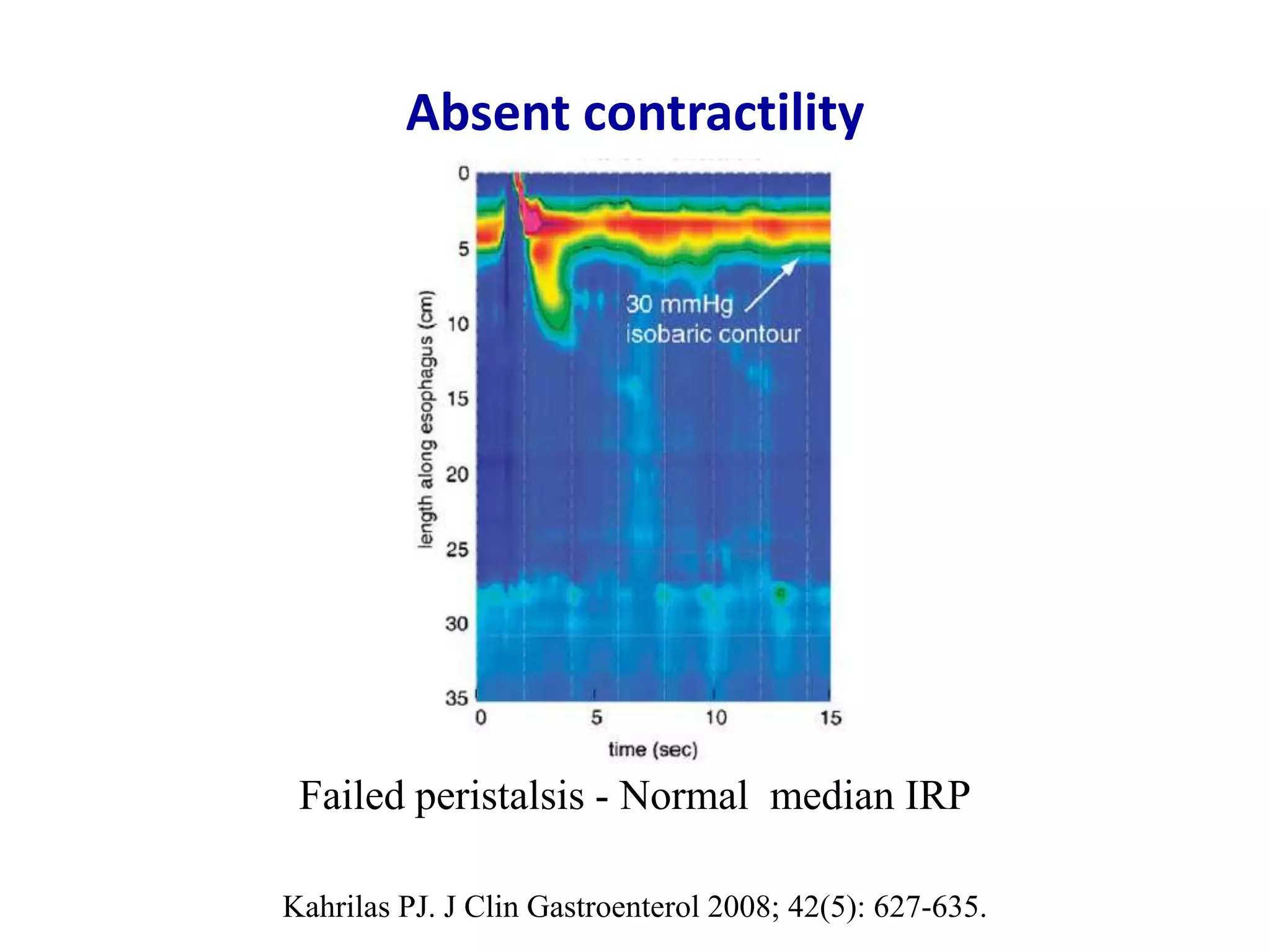 Esophageal motility disorders in Chicago classification v3.0 | PPTX