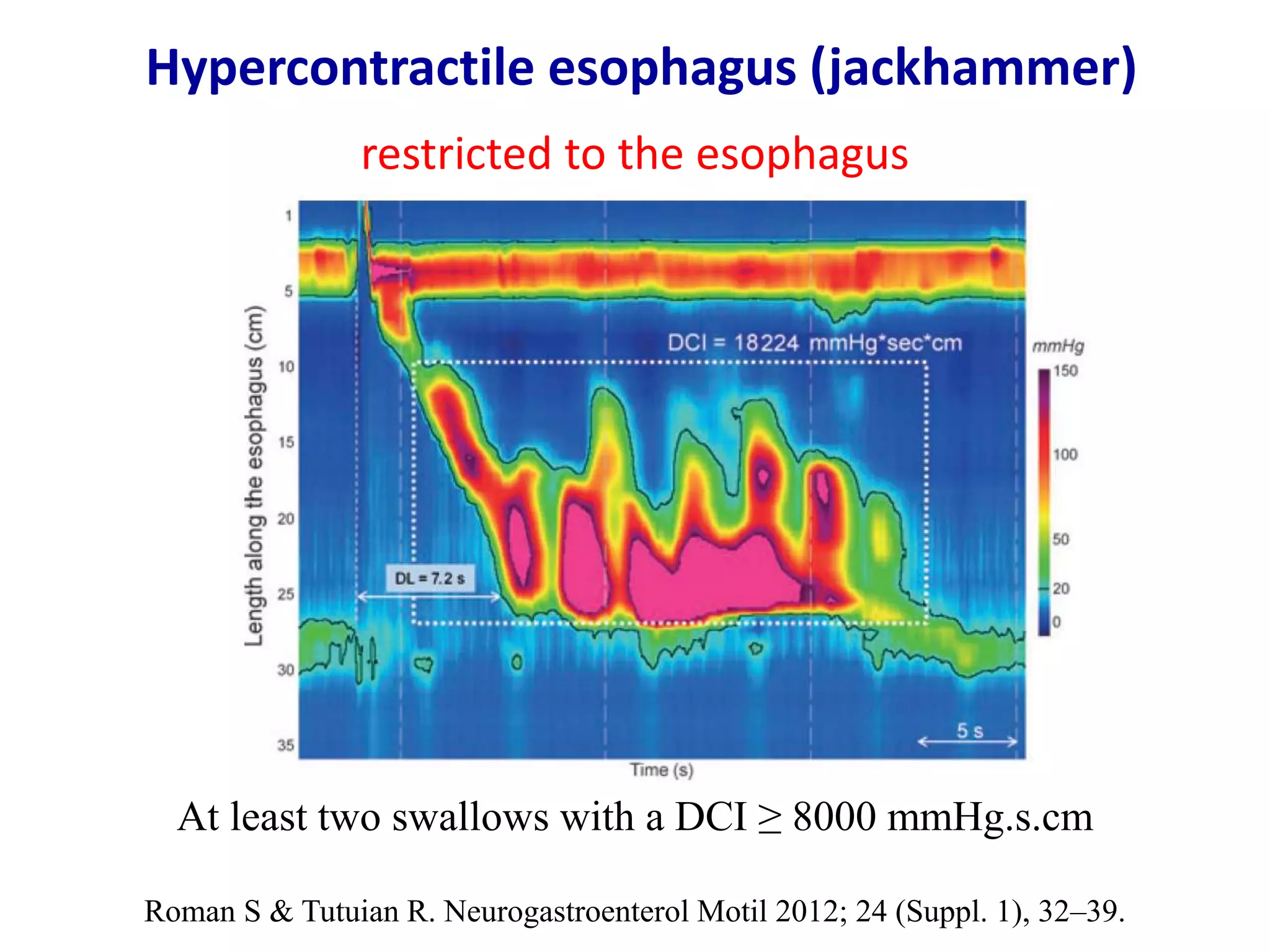 Esophageal motility disorders in Chicago classification v3.0 | PPTX