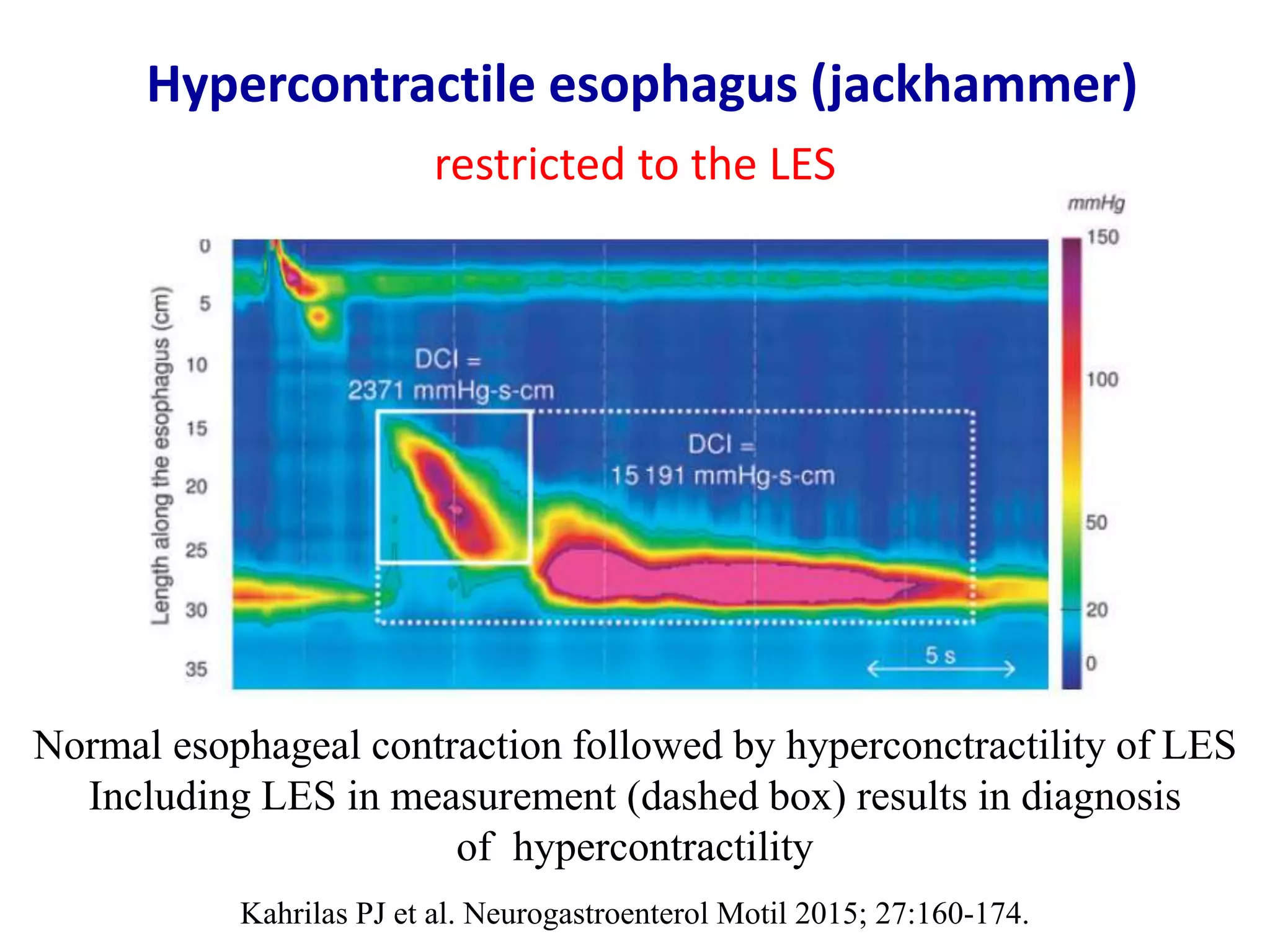 Esophageal motility disorders in Chicago classification v3.0 | PPTX