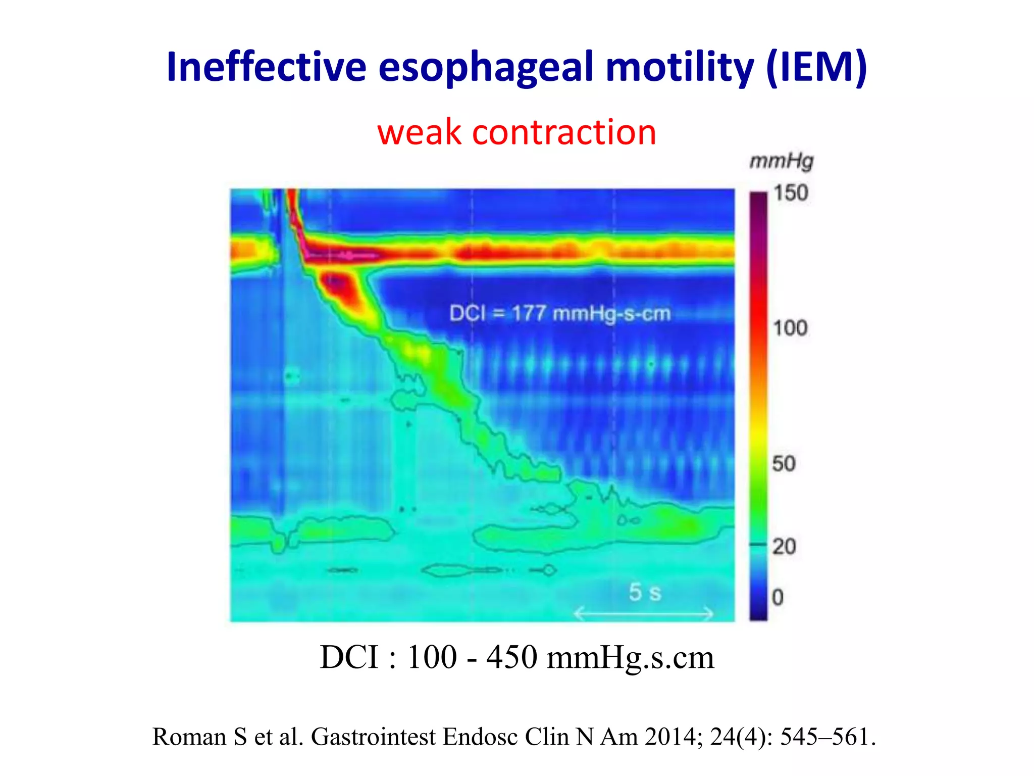 Esophageal motility disorders in Chicago classification v3.0 | PPTX