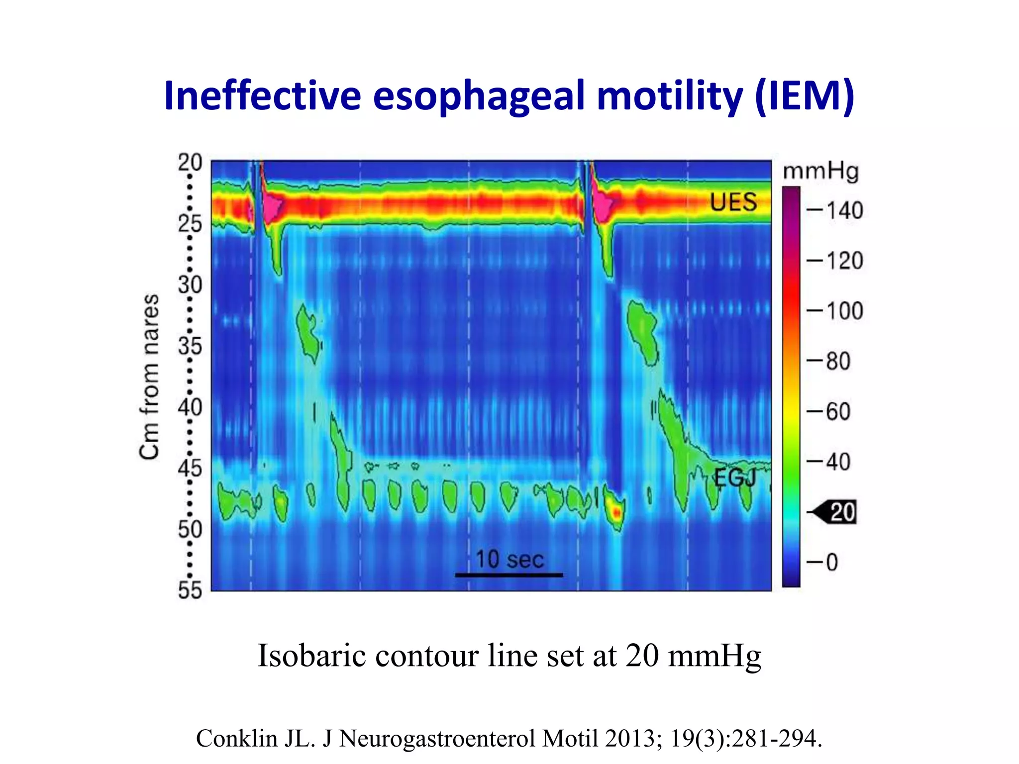 Esophageal motility disorders in Chicago classification v3.0 | PPTX