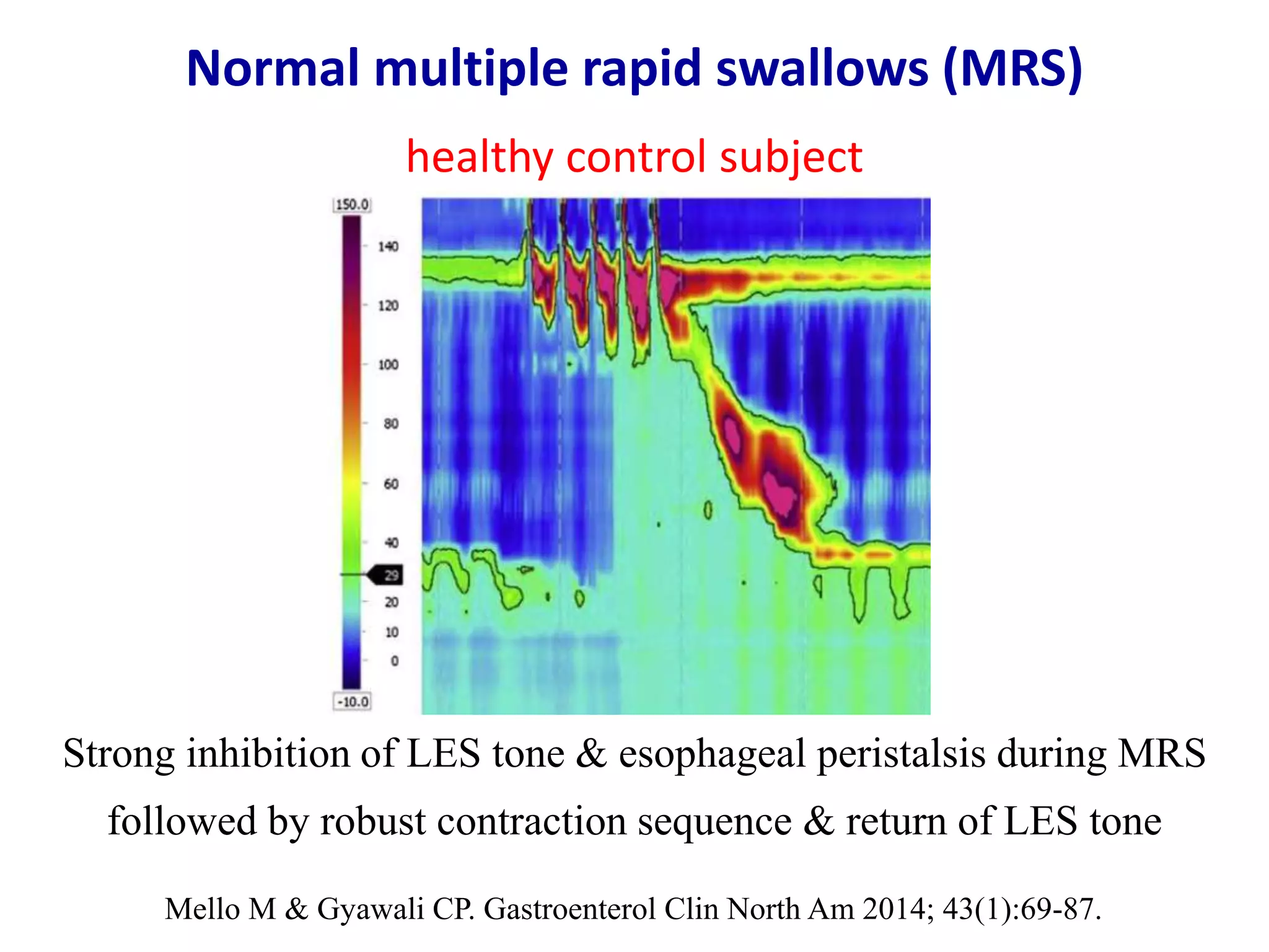 Esophageal motility disorders in Chicago classification v3.0 | PPTX
