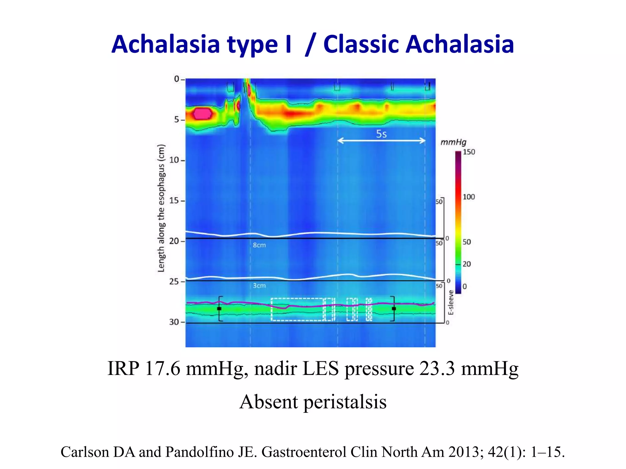 Esophageal motility disorders in Chicago classification v3.0 | PPTX