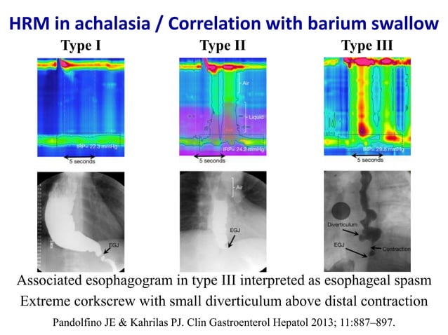 Esophageal motility disorders in Chicago classification v3.0 | PPT