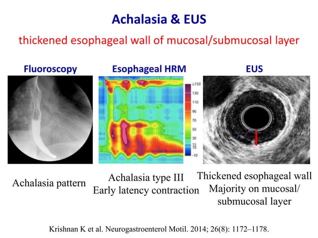 Esophageal motility disorders in Chicago classification v3.0 | PPT