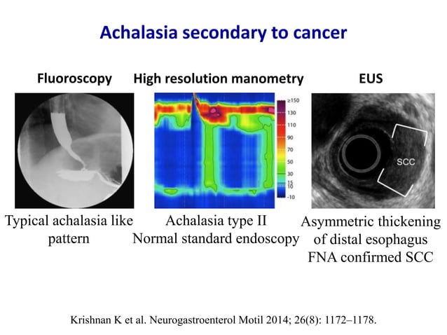 Esophageal motility disorders in Chicago classification v3.0 | PPT