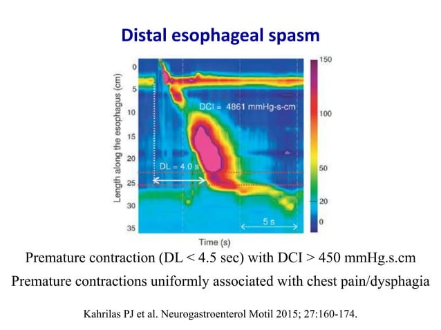 Esophageal motility disorders in Chicago classification v3.0 | PPT