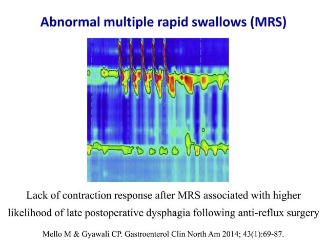 Esophageal motility disorders in Chicago classification v3.0 | PPT