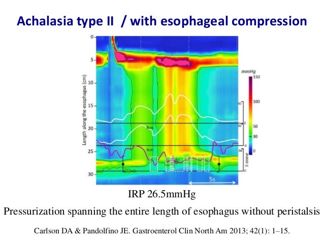 Esophageal motility disorders in Chicago classification v3.0
