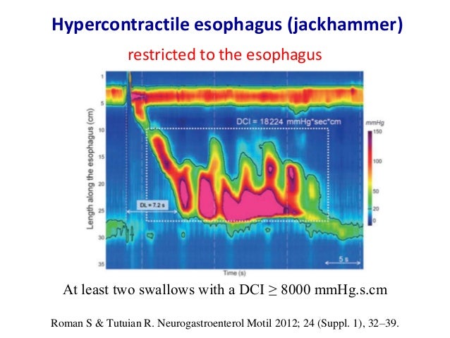 Esophageal motility disorders in Chicago classification v3.0