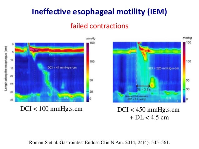 Esophageal motility disorders in Chicago classification v3.0