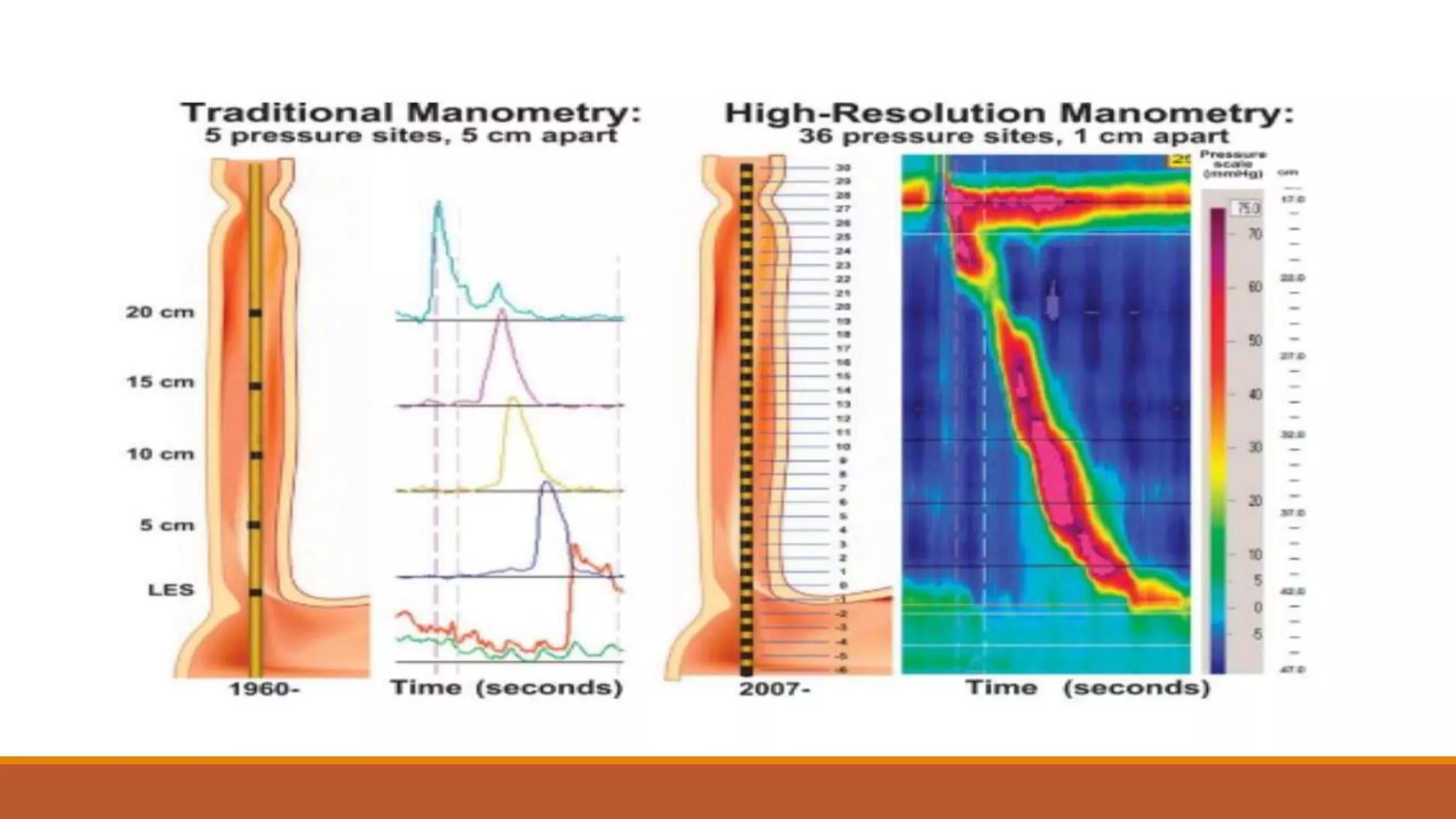 Esophageal motility disorders | PPTX