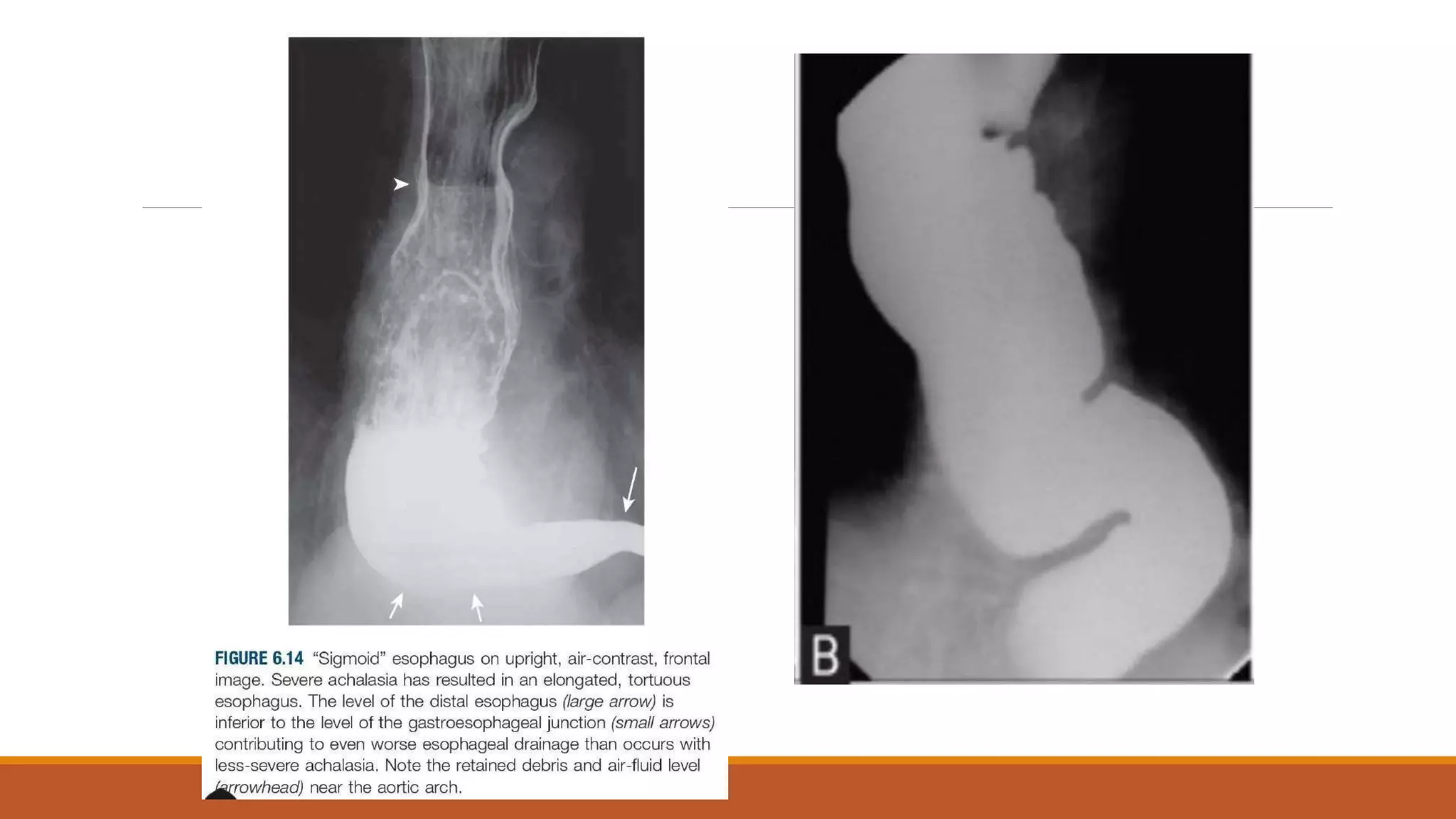 Esophageal motility disorders | PPTX | Digestive Disorders | Diseases ...