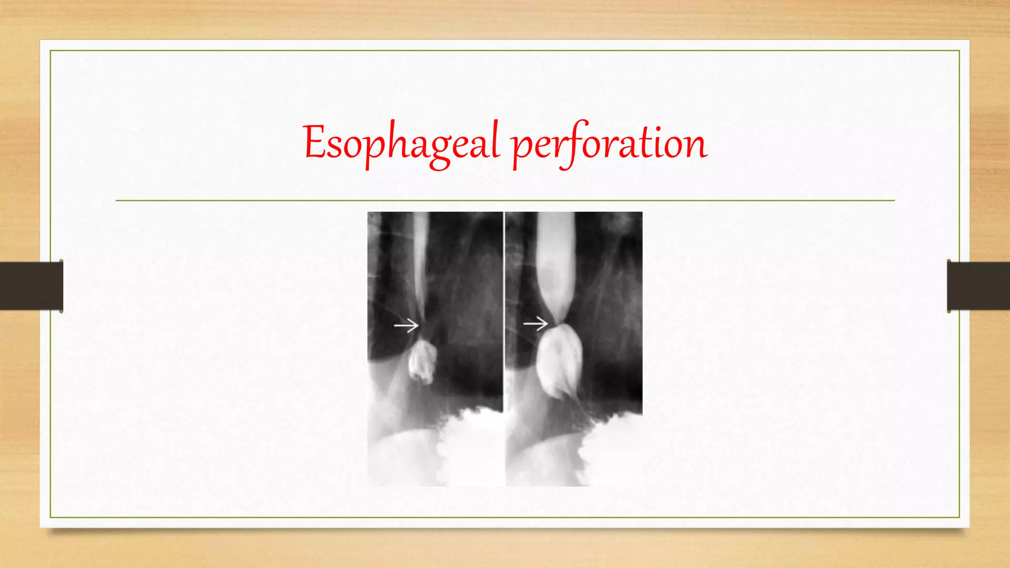 Esophageal perforation.pptx