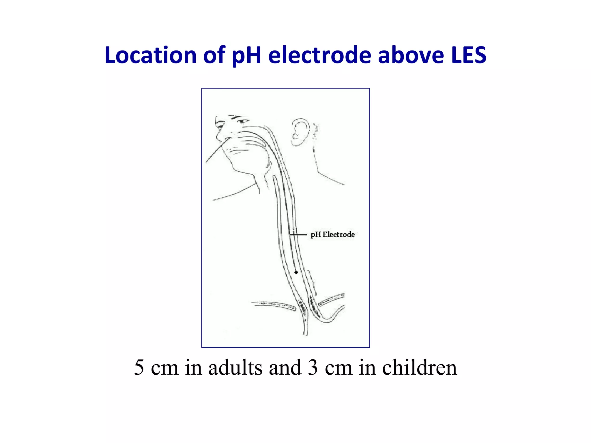 Esophageal pH monitoring in pediatrics | PPTX