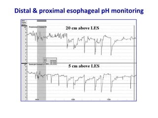 Esophageal pH monitoring in pediatrics | PPTX