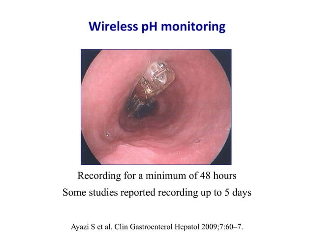 Esophageal pH monitoring in pediatrics | PPTX