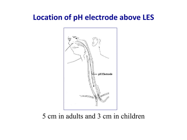 Esophageal pH monitoring in pediatrics | PPTX