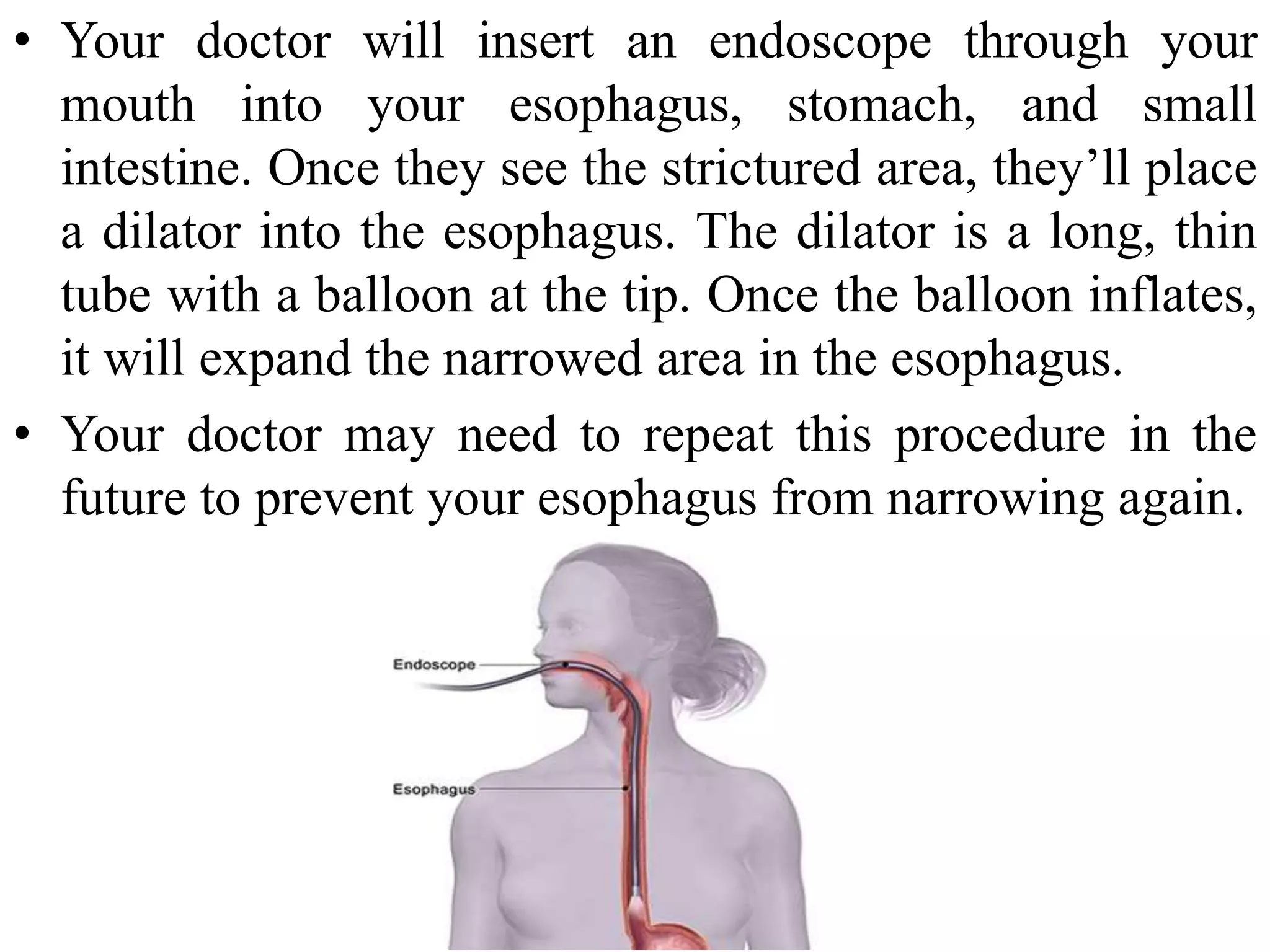 Esophageal stricture | PPTX
