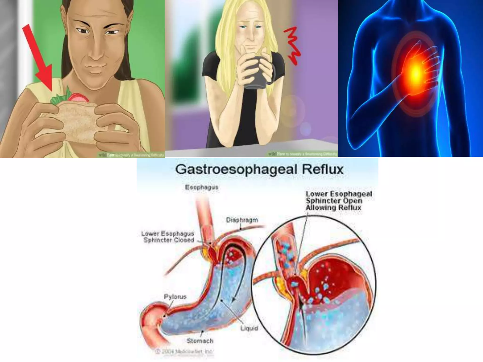 Esophageal stricture | PPTX