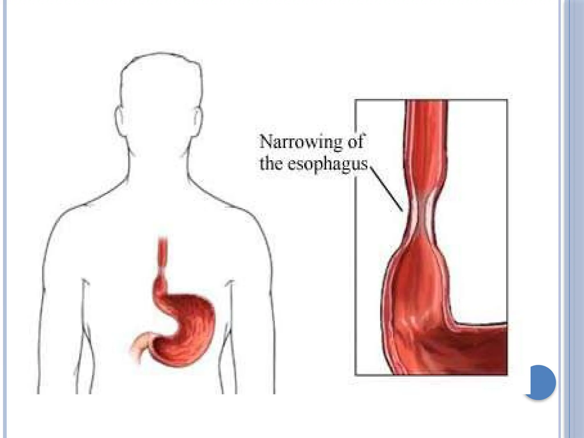 ESOPHAGEAL STRICTURE ppt for nurses.pptx