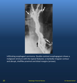 Esophageal Strictures | PDF