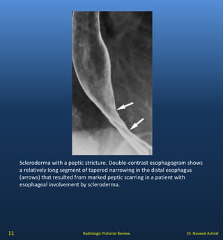 Esophageal Strictures | PDF