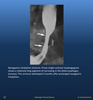 Esophageal Strictures | PDF