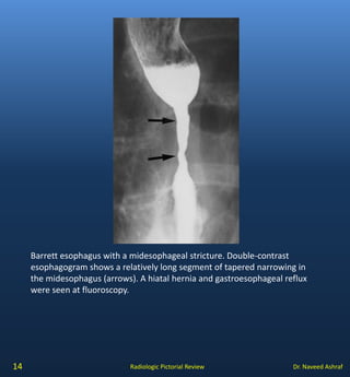 Esophageal Strictures | PDF