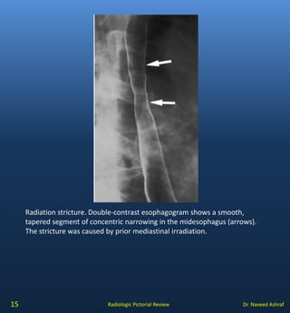 Esophageal Strictures | PDF