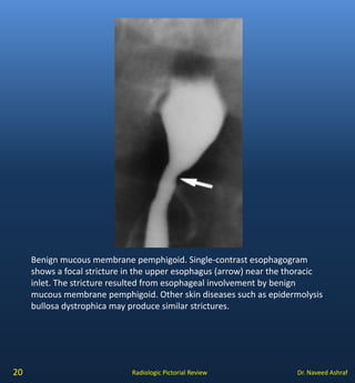 Esophageal Strictures | PDF